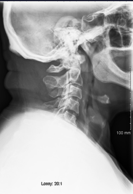 Ossification Posterior Longitudinal Ligament Spine Orthobullets